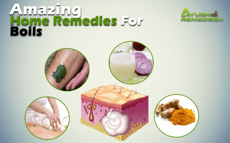2 Amazing Home Remedies for Boils - Straight Out Of Kitchen!