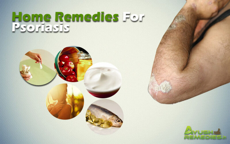6 Best Home Remedies for Psoriasis, Natural Treatment