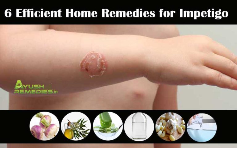 6 Home Remedies for Impetigo in Adults and Children that Work