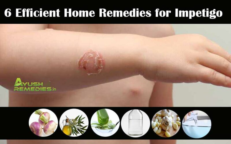 6 Home Remedies for Impetigo in Adults and Children that Work